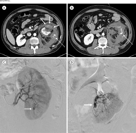 Figure 1 From Transarterial Embolization For Sporadic Renal Angiomyolipoma Patient Selection