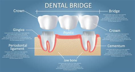 Dental Bridges Types Fitting And Costs Polident