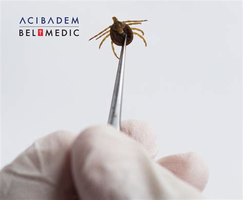 Kako Prepoznati Ujed Krpelja I Zaštita Dece Od Krpelja Acibadem Bel