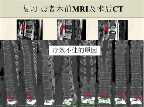椎体成形中骨水泥充分填充的技巧及意义 好医术早读文章 好医术 赋能医生守护生命
