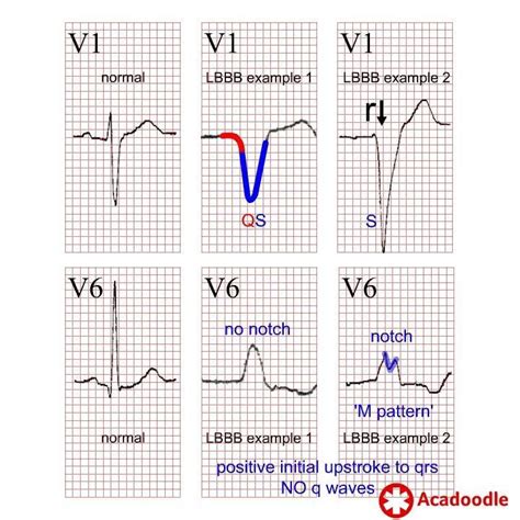 Left Bundle Branch Block Lbbb Ecg Criteria Causes 43 Off
