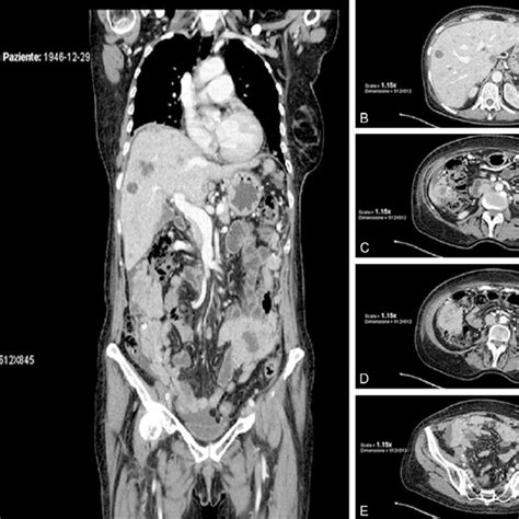 computerized tomography features six month after surgery nodular
