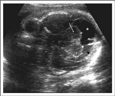 Figure 1 From The Fetal Cerebellum Semantic Scholar
