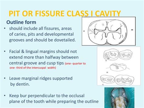 Ppt Cavity Preparation For Amalgam Class I Powerpoint Presentation