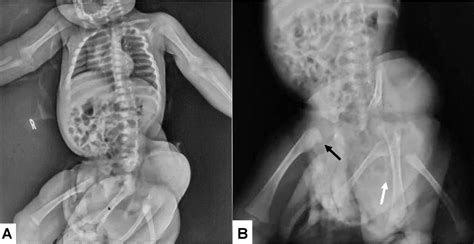 Figure 1 From Thoracolumbar Rachipagus Parasitic Twins With Multiple Congenital Anomalies A