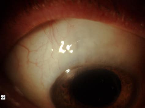 Sonoran Desert Eye Center Bleb From Trabeculectomy