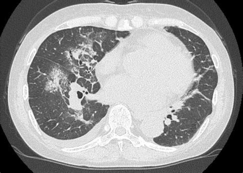 Thoracic Ct Imaging Thoracic Ct Showing Diffuse Lung Consolidation In Download Scientific