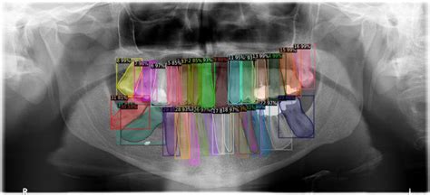 Ai Deeplearning Detectron2 Maskrcnn Toothsegmentation