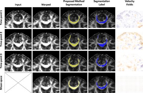 Learning Unbiased Registration And Joint Segmentation Evaluation On Longitudinal Diffusion Mri