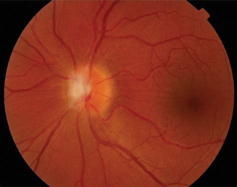Typical And Atypical Optic Neuritis Diagnosis And Initial Management