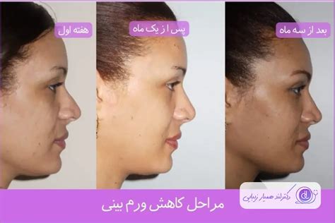 ورم بینی و 5 راهکار موثر برای کاهش ورم بینی بعد از عمل