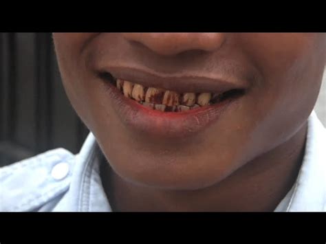Betel Nut Teeth Betel Chewing In China Wikipedia