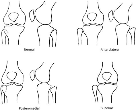 Dislocation Of The Proximal Tibiofibular Joint Do Not Miss It Bmj Case Reports