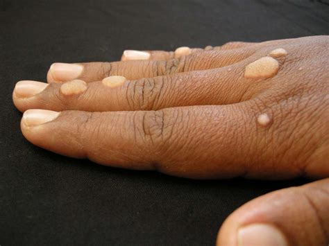 5 Types Of Warts Pictures And How To Treat Them