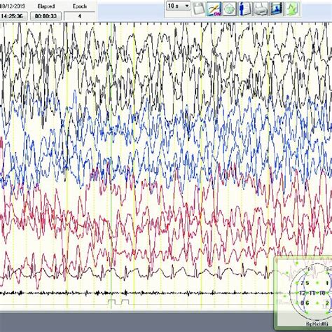 ictal eeg eeg electroencephalogram download scientific diagram