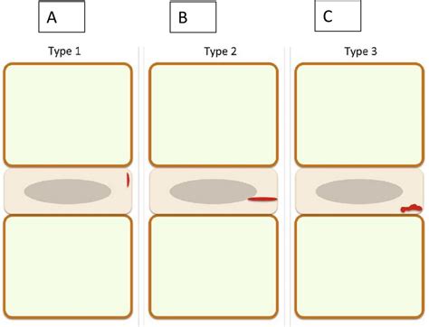 Yu Et Al Classification Of Intervertebral Dic Fissures Download