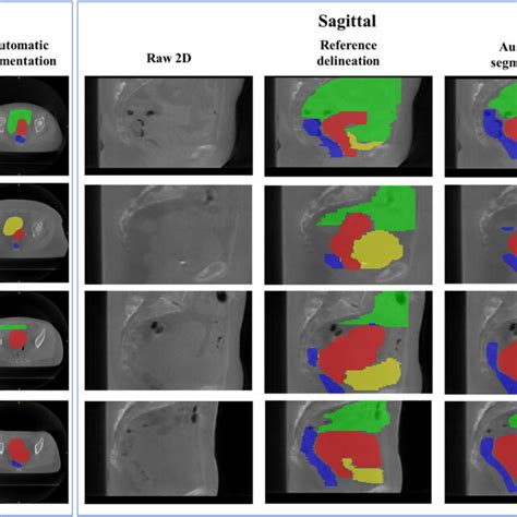 Examples Of Segmentation On Cbct The Contours Are Represented On The