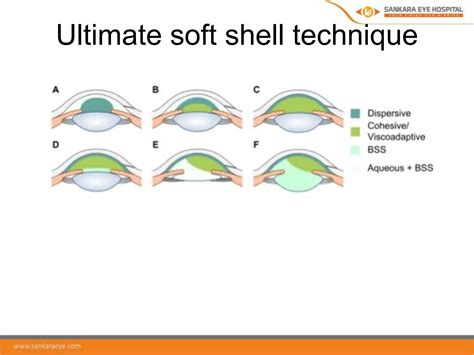 Ophthalmic Viscosurgical Devices Pptx