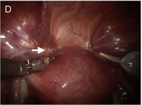 Laparoscopy Revealed Extensive Deep Infiltrating Endometriosis With Download Scientific Diagram