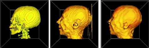 Left An Adaptive Resolution Isosurface Corresponding To Bone