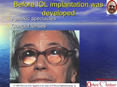 Cataract And Implant Surgery Ppt