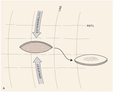 6 Flap Classification And Design Pocket Dentistry
