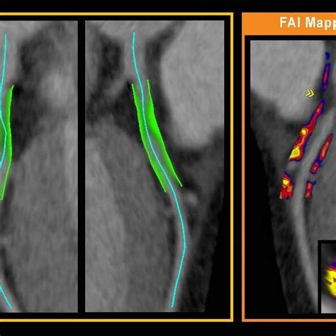 In Chronological Order The Figure Includes 1 Case 1 Ccta Scan