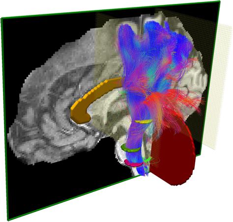 illustration of the dissection plan of the pyt using the mi‐brain