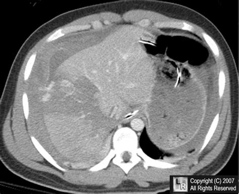 Learning Radiology Liver Laceration Hepatic