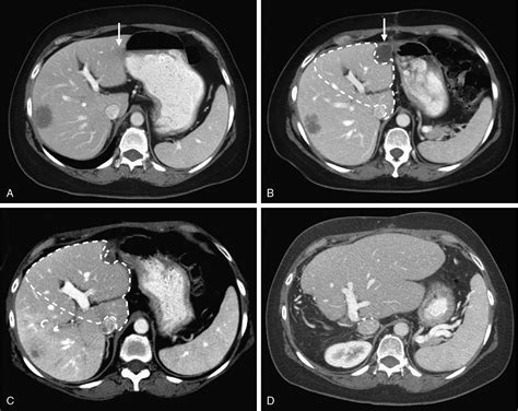 Hepatic Resection For Benign And Malignant Liver And Biliary Tract Disease Indications And
