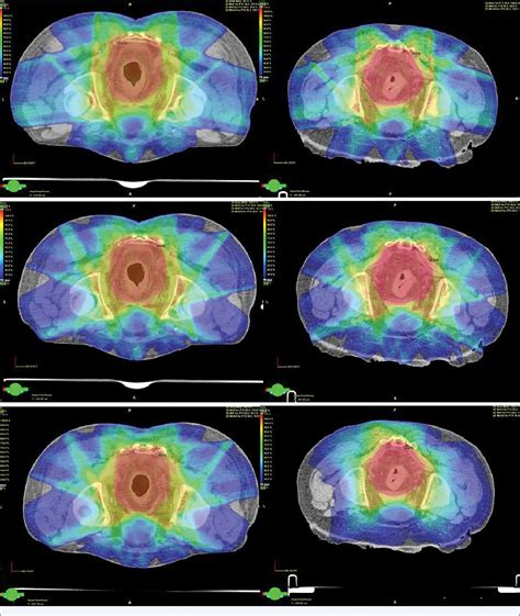 Figure 1 From Dosimetric Comparison Of Intensity Modulated Radiotherapy