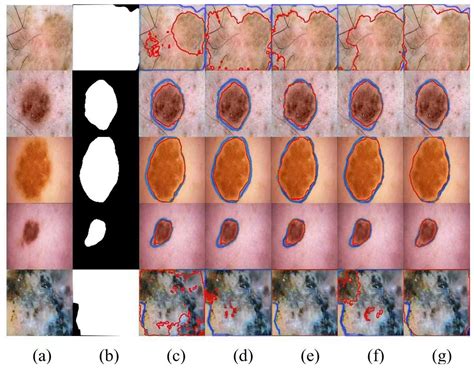 sutrans net a hybrid transformer approach to skin lesion segmentation