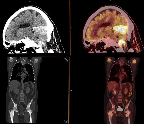 Pet Ct Showing A Hypermetabolic Extraaxial Dural Based Masses In The