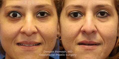 Orbital Decompression Center For Eye And Facial Plastic Surgery