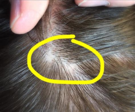 Early Pseudopelade Of Brocq — Donovan Hair Clinic
