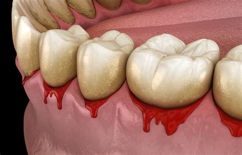 What Causes Gum Disease