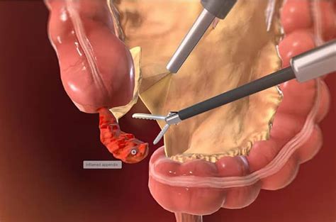 Appendix Surgery M B Patel Hospital Best Plastic Surgery Hospital