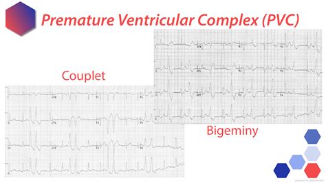 Aritmia Workshop Ekg Dokter Alfa Belajar Kedokteran