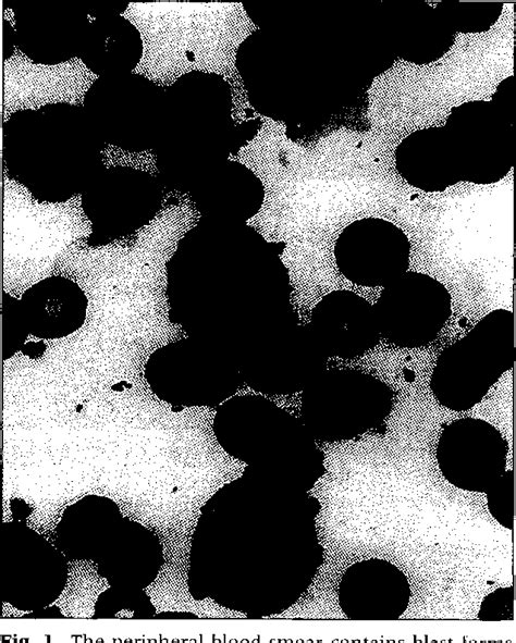 Figure 1 From Pyoderma Gangrenosum Associated With Acute Megakaryoblastic Leukemia Semantic