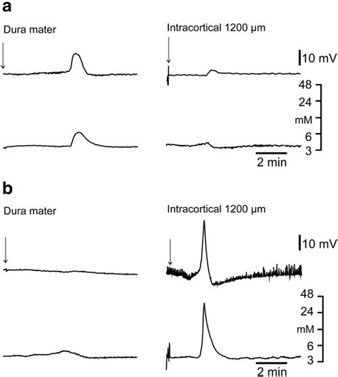 Not All Csd Could Be Picked Up Both At The Surface Of The Dura Mater