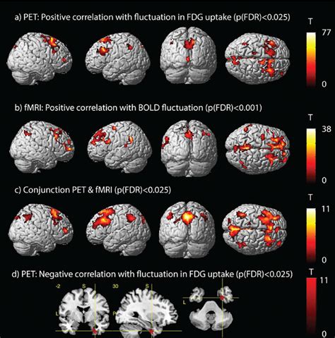 Spatial Maps For Seed Based Correlations With The Dorsal Poste Ured