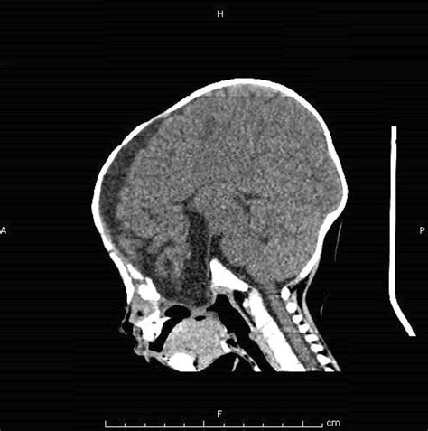 Post Operative Ct Image Showing Successful Repair Of The Defect Download Scientific Diagram