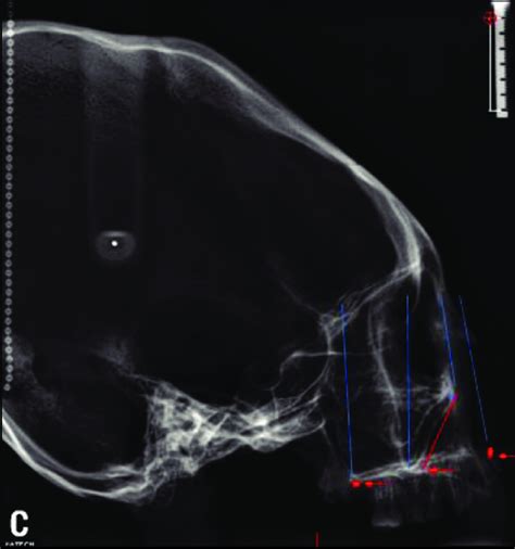 Nasomaxillary Complex The Structures Of The Naso Malar Complex Such