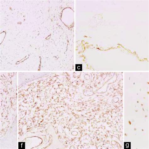 Vaginal Stromal Polyp Immunohistochemical Fi Ndings A Desmin Download Scientific Diagram