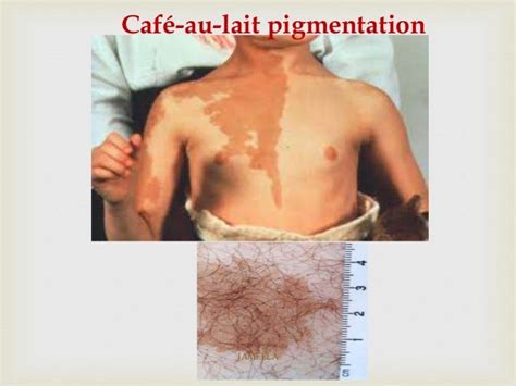 Fibrous Dysplasia Of Jaw