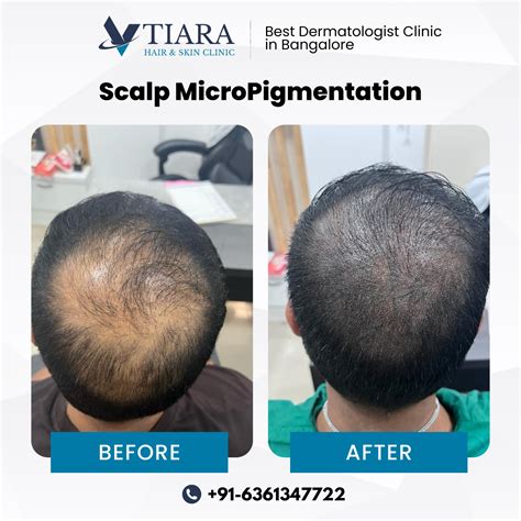 Scalp Micropigmentation In Bangalore Best Hair Loss Treatment