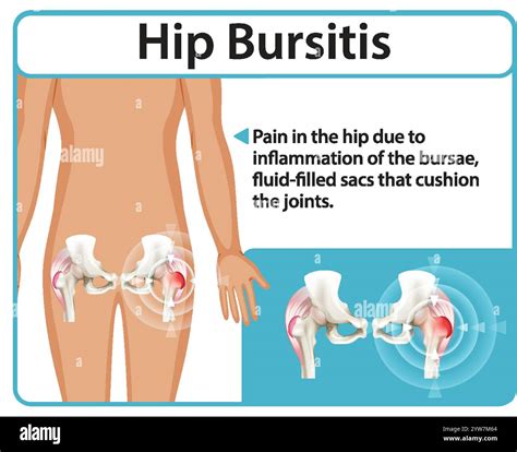 Bursitis Of The Hip Stock Vector Images Alamy