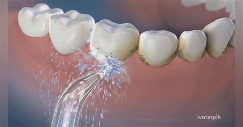 String Floss Vs Water Flossing Dentistry Iq