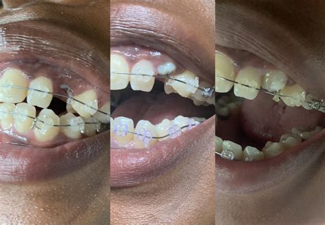 1681 Best R Braces Images On Pholder November 2010 Vs March 2020 4 Years Of Braces Double