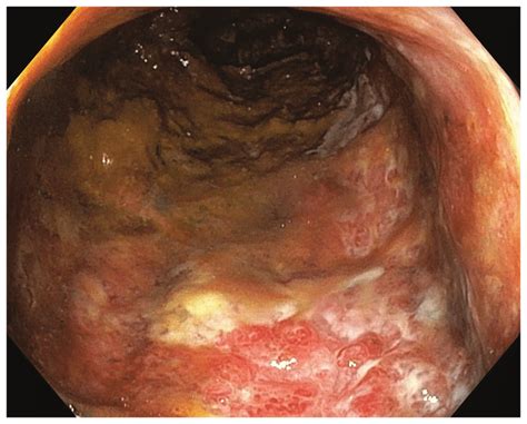 Photograph Of The Sigmoid Colon Taken During The Colonoscopy Of A Download Scientific Diagram